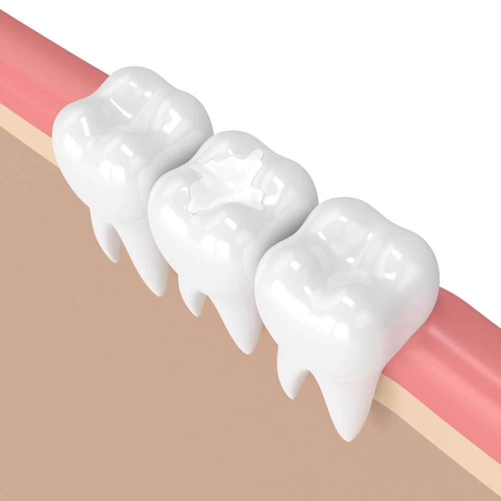 Bonding and White Filling - Friendly Dental of Worcester